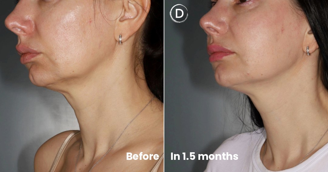 Sofwave - Dermatology Circle NYC