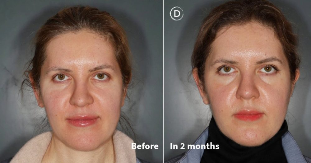 Sofwave - Dermatology Circle NYC