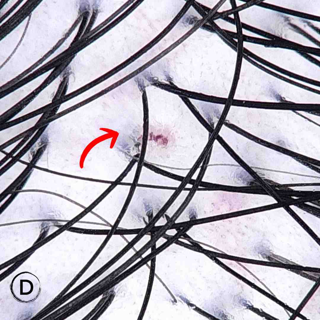 Scalp Acne - Dermatology Circle NYC